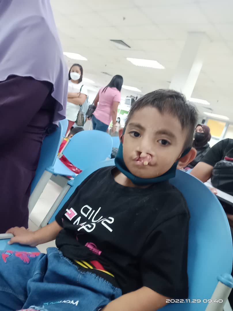 Dana Bantuan Pembedahan Sumbing Mulut & Lelangit - KentangFund.com:马铃薯叔叔基金